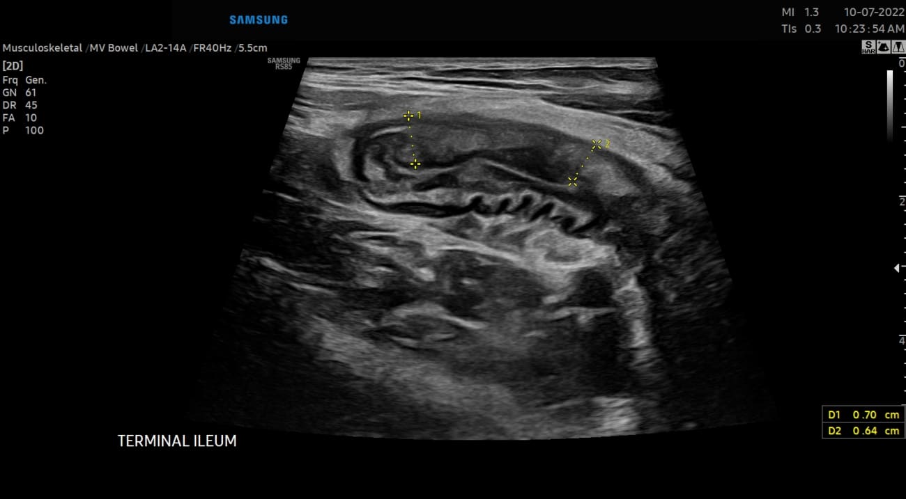 Mount Sinai Brings Patient-Centric Intestinal Ultrasound to North ...