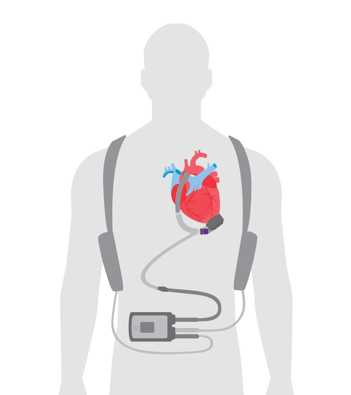 Mechanical Circulatory Support: Left Ventricular Assist Devices (LVAD ...