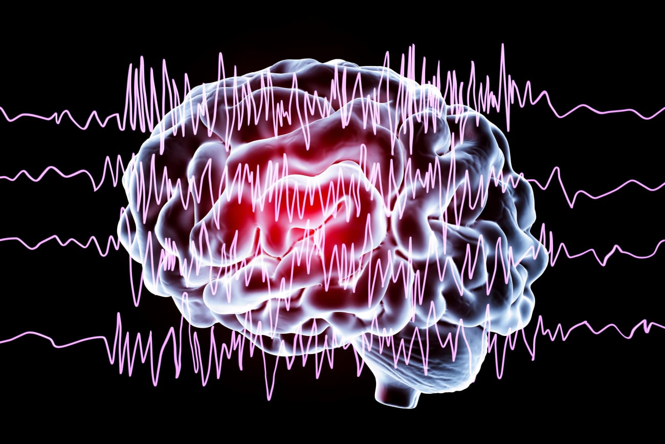 New Tools Map Seizures, Improve Epilepsy Treatment - BroadcastMed