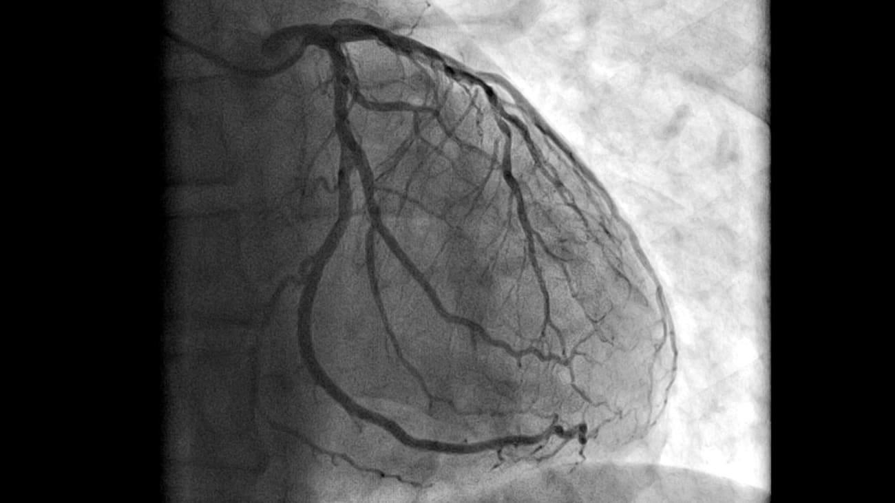 Can Artificial Intelligence Reduce Invasive Testing and Improve Cardiac ...