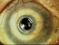 at press time | Ophthalmology Management