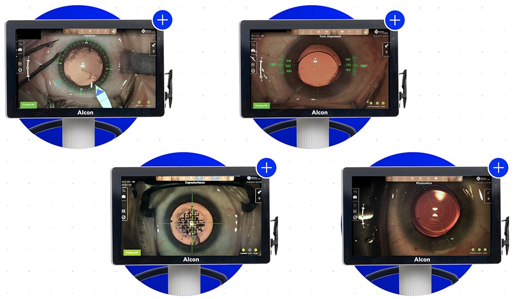 Managing Astigmatism In the OR Just Got Easier | Ophthalmology Management