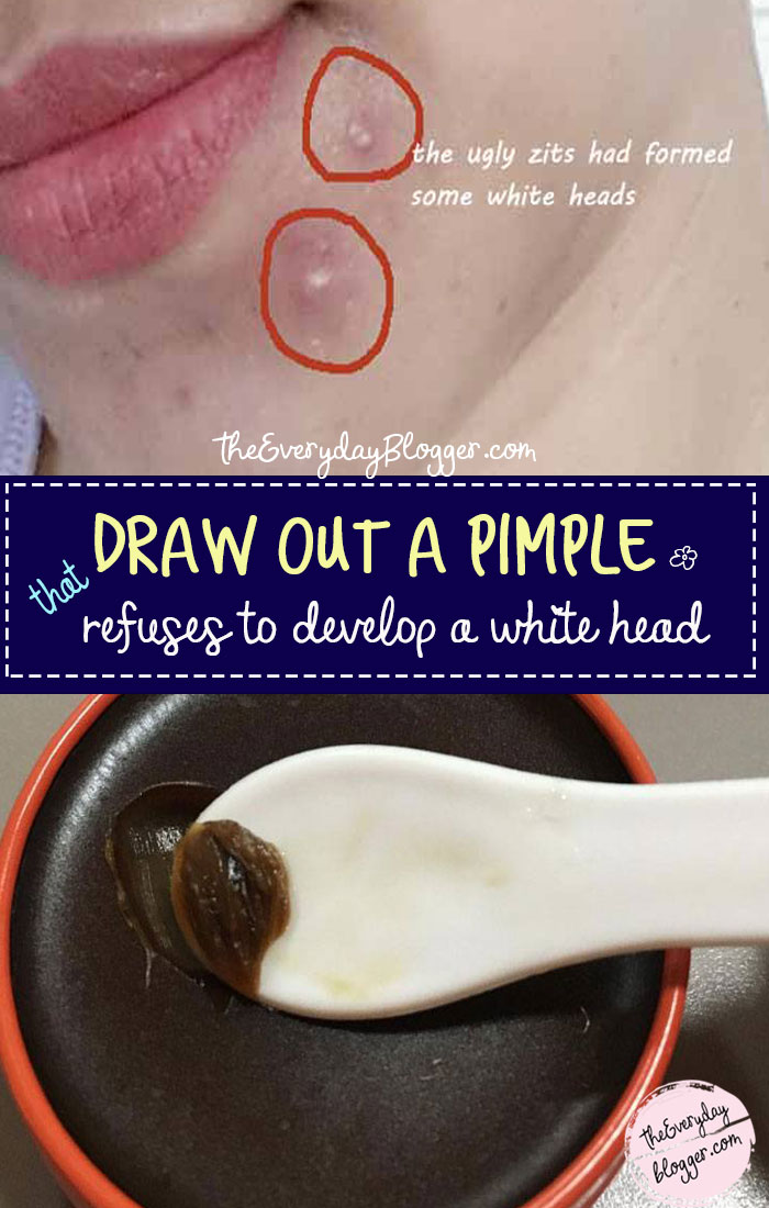 How To Draw Out A Pimple – How to Bring a Pimple to a Head - The ...