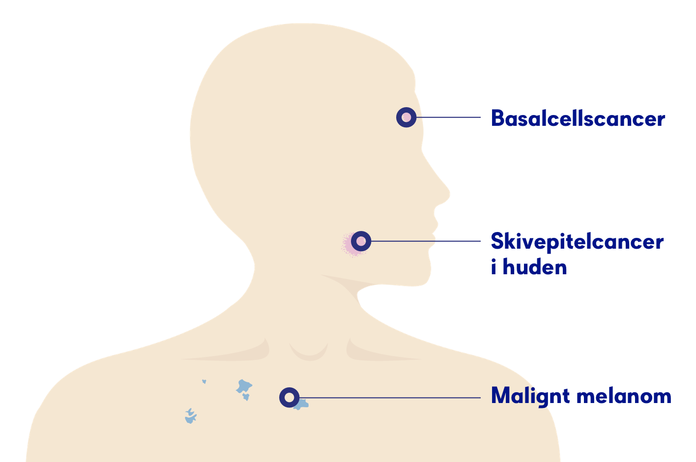 Malignt melanom – symtom, orsaker och behandling | Cancerfonden