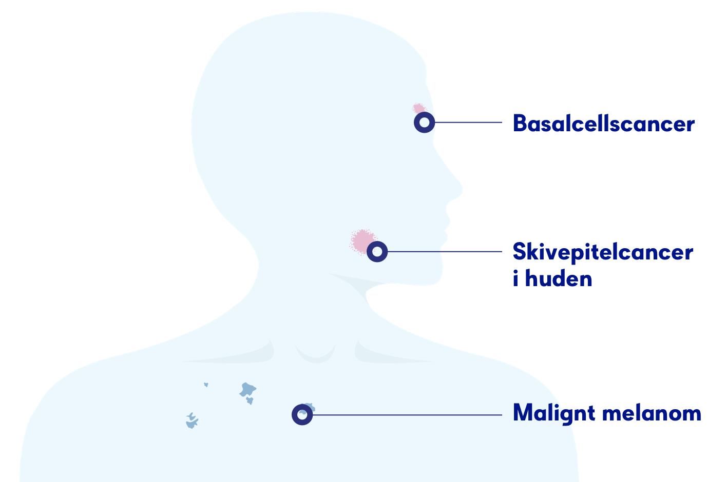 Basalcellscancer (basaliom) – hudcancer | Cancerfonden