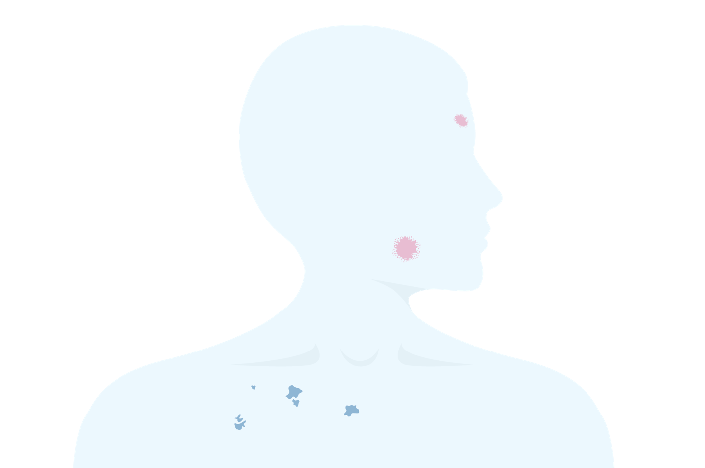 Hudcancer – symtom, orsak och behandling | Cancerfonden
