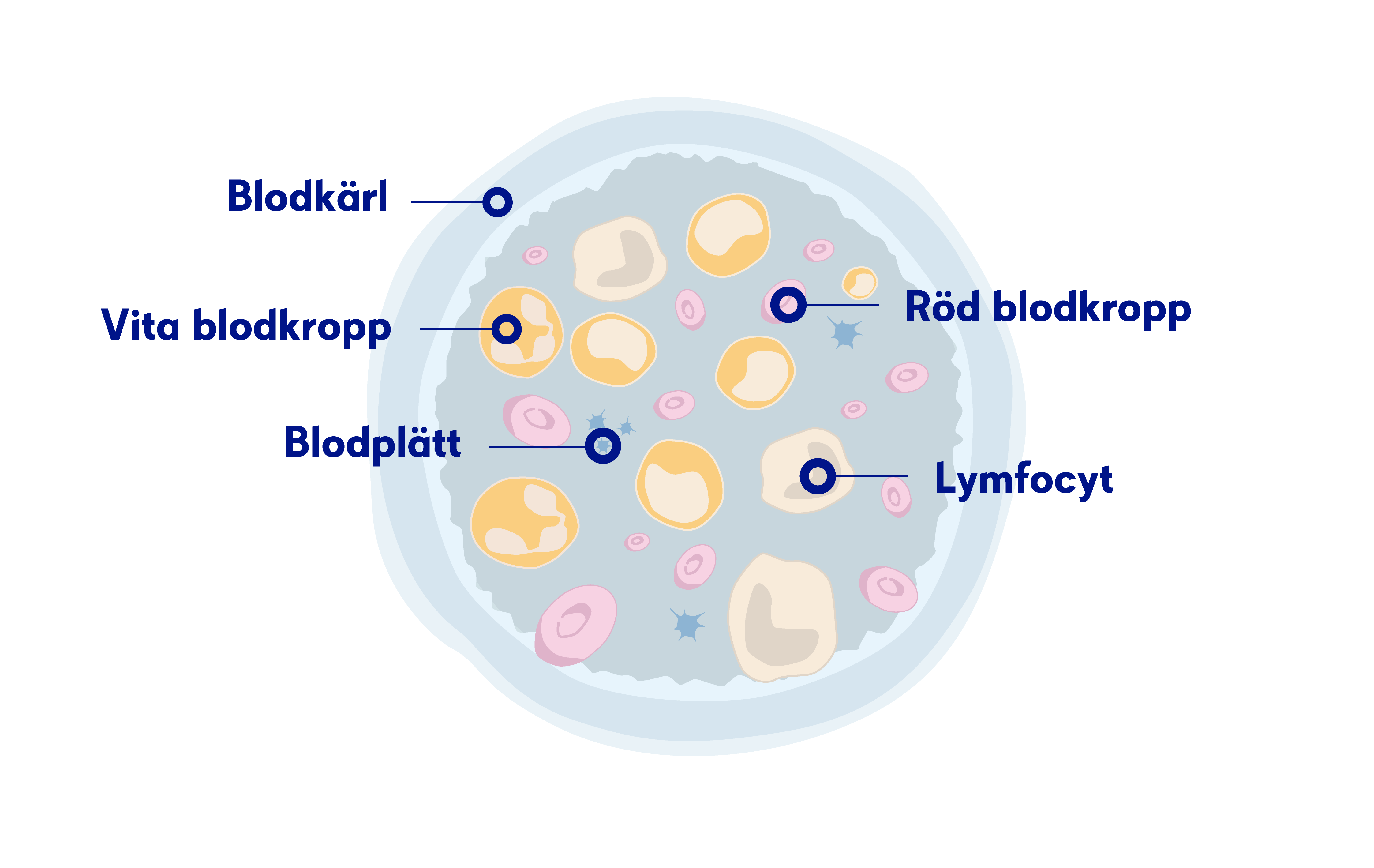 Akut lymfatisk leukemi (ALL) | Cancerfonden