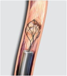 Cook Medical G32701 - EXTRACTOR, STONE, NCOMPASS, NITINOL, TIPLESS ...