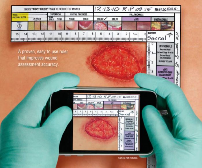 Medline MSCNE1TOOL - TOOL, WOUND ASSESSMENT, NE1, 100/BX, 100 EA/BX ...