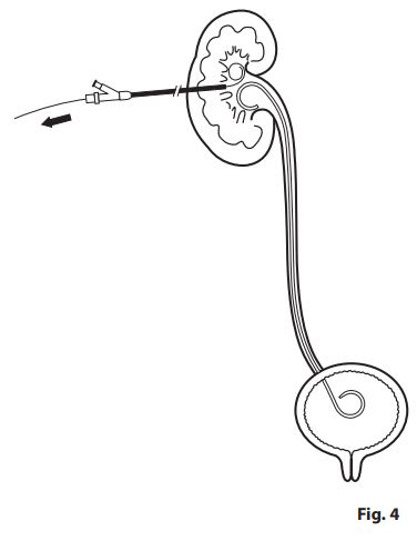 Cook Medical G09709 - SET, STENT, ULTRA, UTSSW-8.5-24-AMP-RH, EACH ...