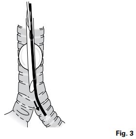 Cook Medical G13280 - SET, ARNDT, ENDOBRONCHIAL, BLOCKER, 5FR, 65CM ...