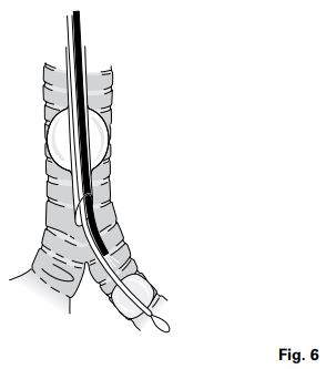 Cook Medical G13280 - SET, ARNDT, ENDOBRONCHIAL, BLOCKER, 5FR, 65CM ...