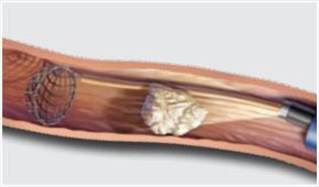 Cook Medical G32724 - DEVICE, NTRAP, ENTRPMNT, EXTRCTN, NTP-028145 ...