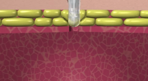 Applied Medical Technology M1-2-1410-I - AMT 14F MiniOne Capsule Non ...