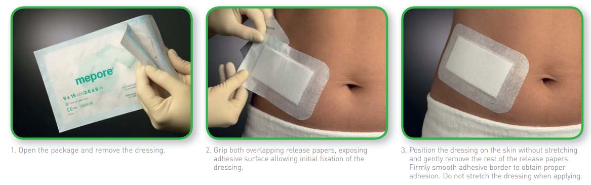 Molnlycke 671000 - DRESSING, MEPORE, 3.6"X6", 50/BX - CIA Medical