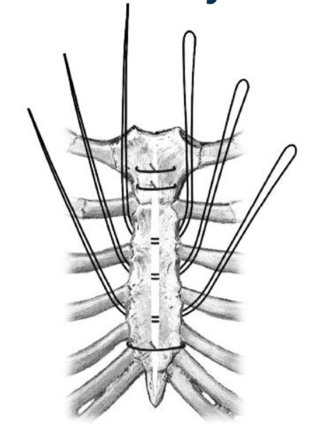 Alto Development 040-400 - TWISTER, DOUBLEWIRE, NON-STERILE, EACH - CIA ...