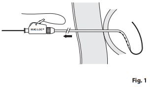 Cook Medical G12685 - TDCS-100-L TM PEDIATRIC CECOSTOMY CATH S, EACH ...