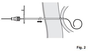 Cook Medical G12685 - TDCS-100-L TM PEDIATRIC CECOSTOMY CATH S, EACH ...