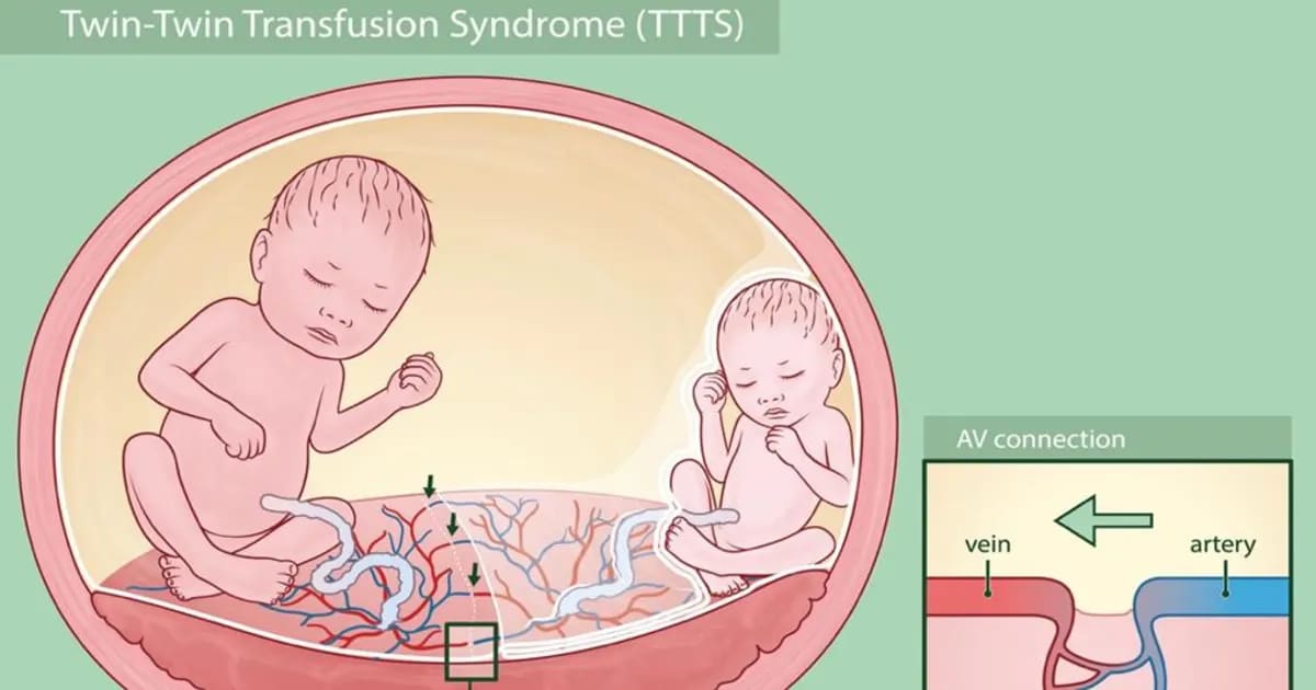 Twin to Twin Transfusion syndrome: controversies in the diagnosis and ...