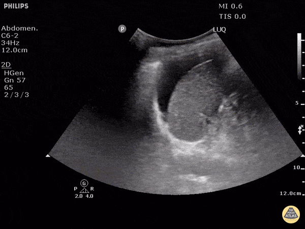 Ultrasound Quiz 7: Need to stop that bleeding, FAST