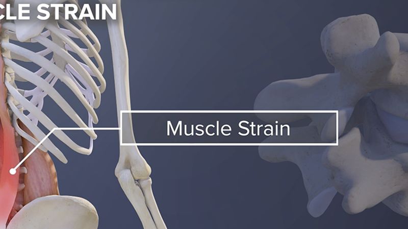 Video: What Is Your Back Muscle Spasm Telling You? | Spine-health