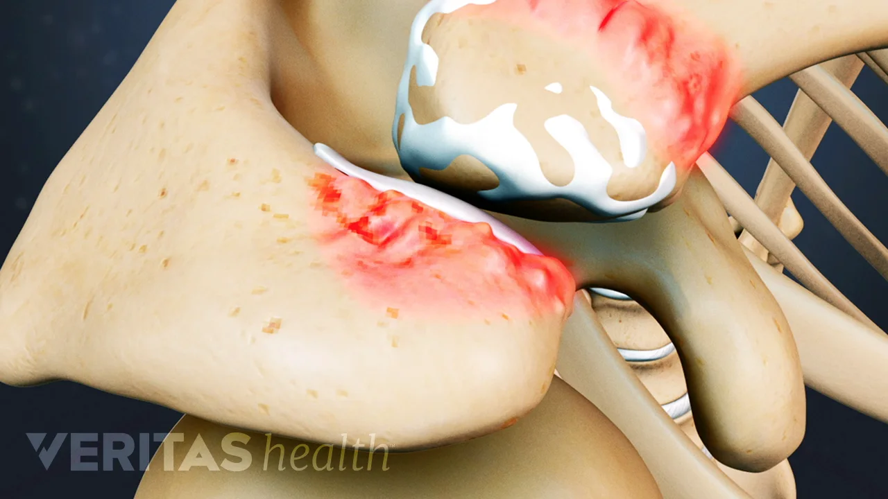 Diagnosis of Bone Spurs | Spine-health