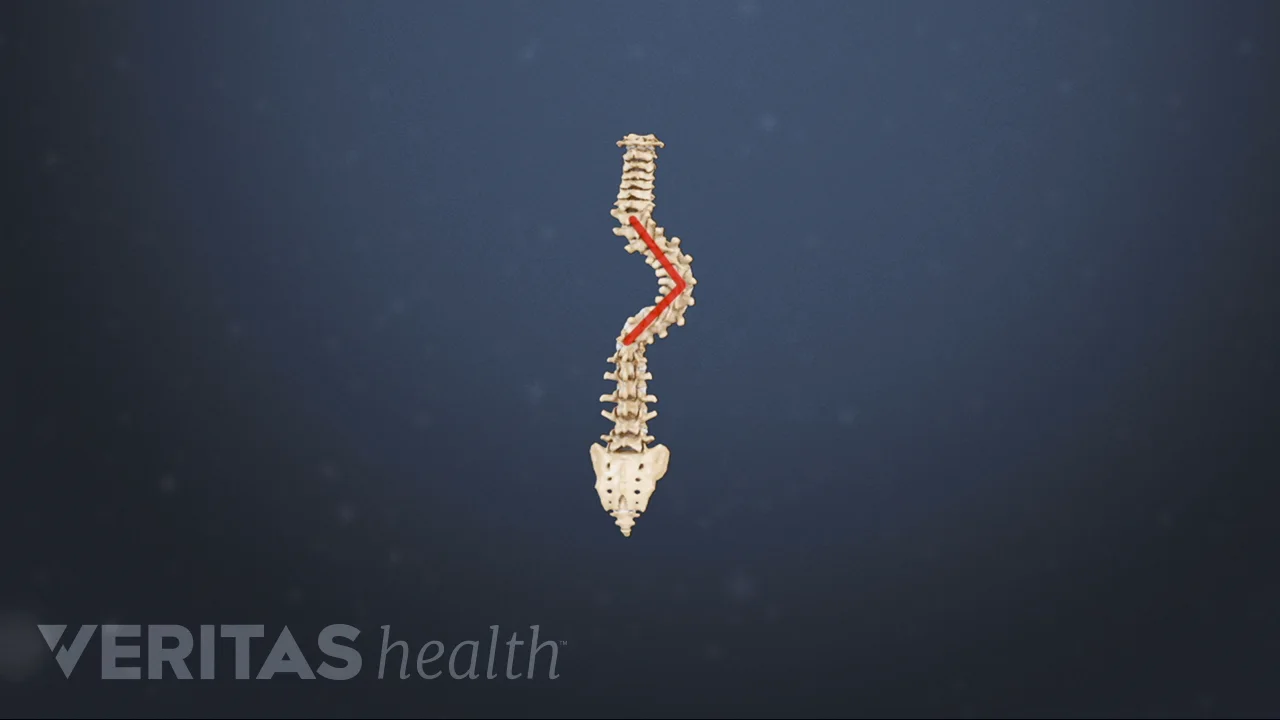 Cobb Angle Measurement and Treatment Guidelines | Spine-health