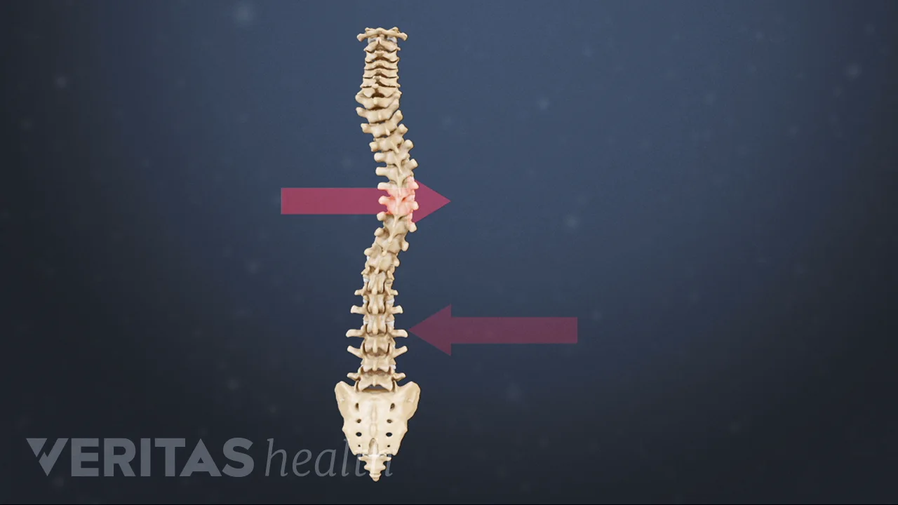 Scoliosis Surgery: Potential Risks and Complications | Spine-health