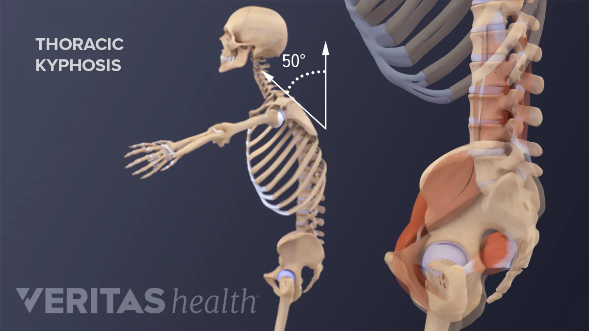 Thoracic Kyphosis: Forward Curvature of the Upper Back | Spine-health