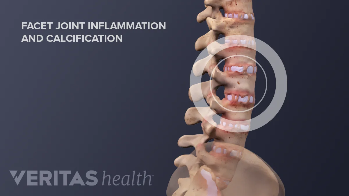 Progression of Ankylosing Spondylitis in the Spine | Arthritis-health