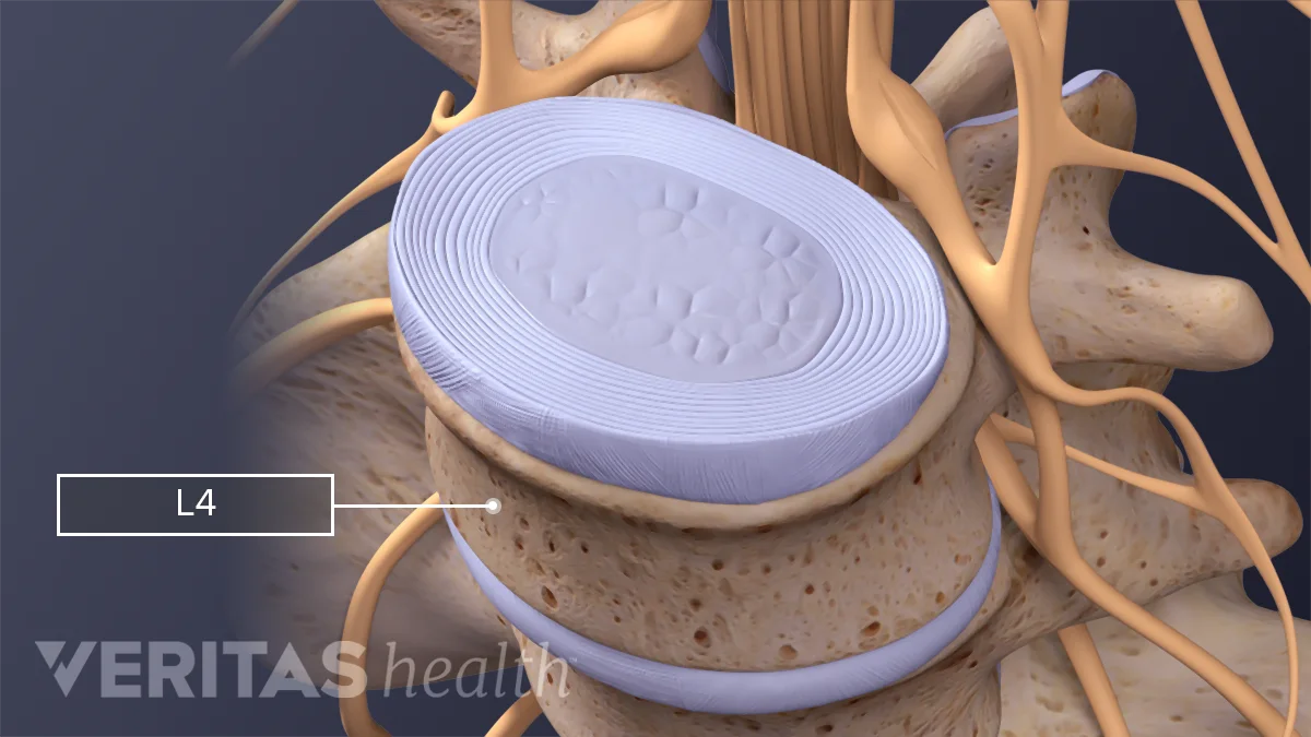 L3-L4 Treatment | Spine-health