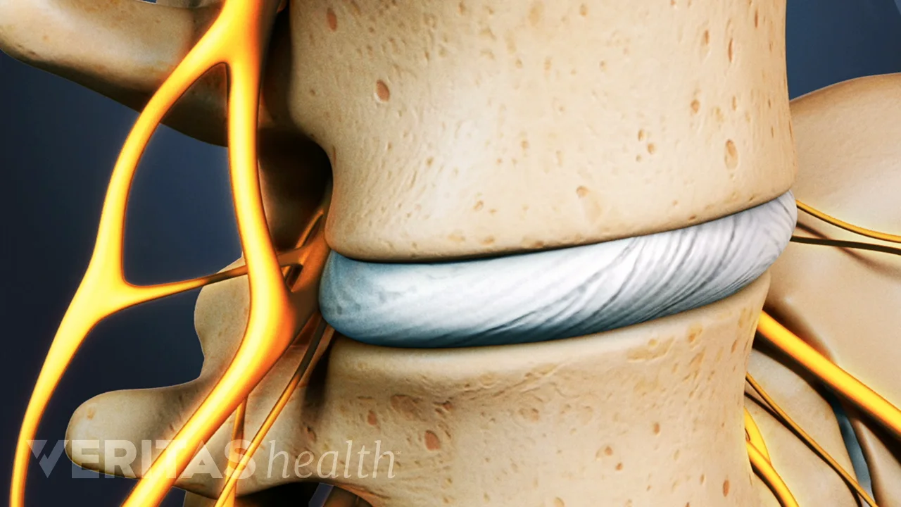 Anterior Lumbar Interbody Fusion (ALIF) Surgery | Spine-health