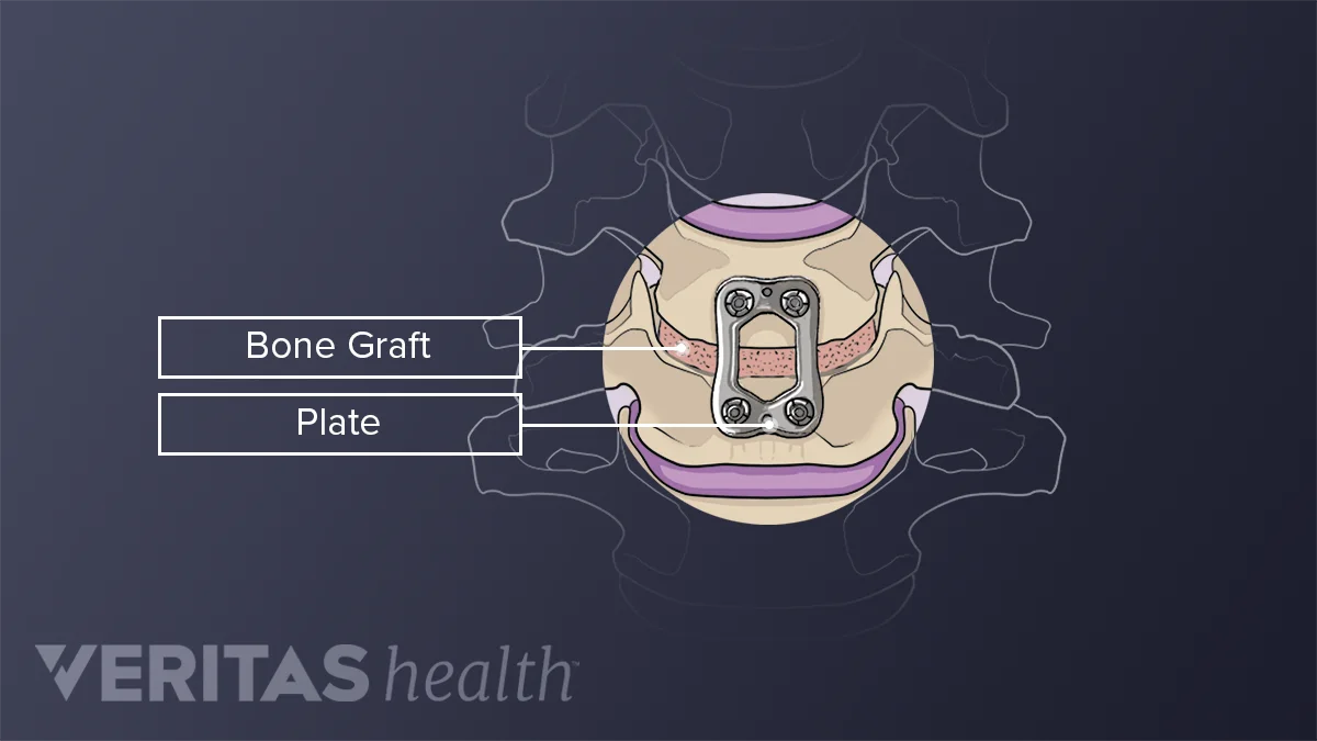 Bone Graft for Spine Fusion | Spine-health