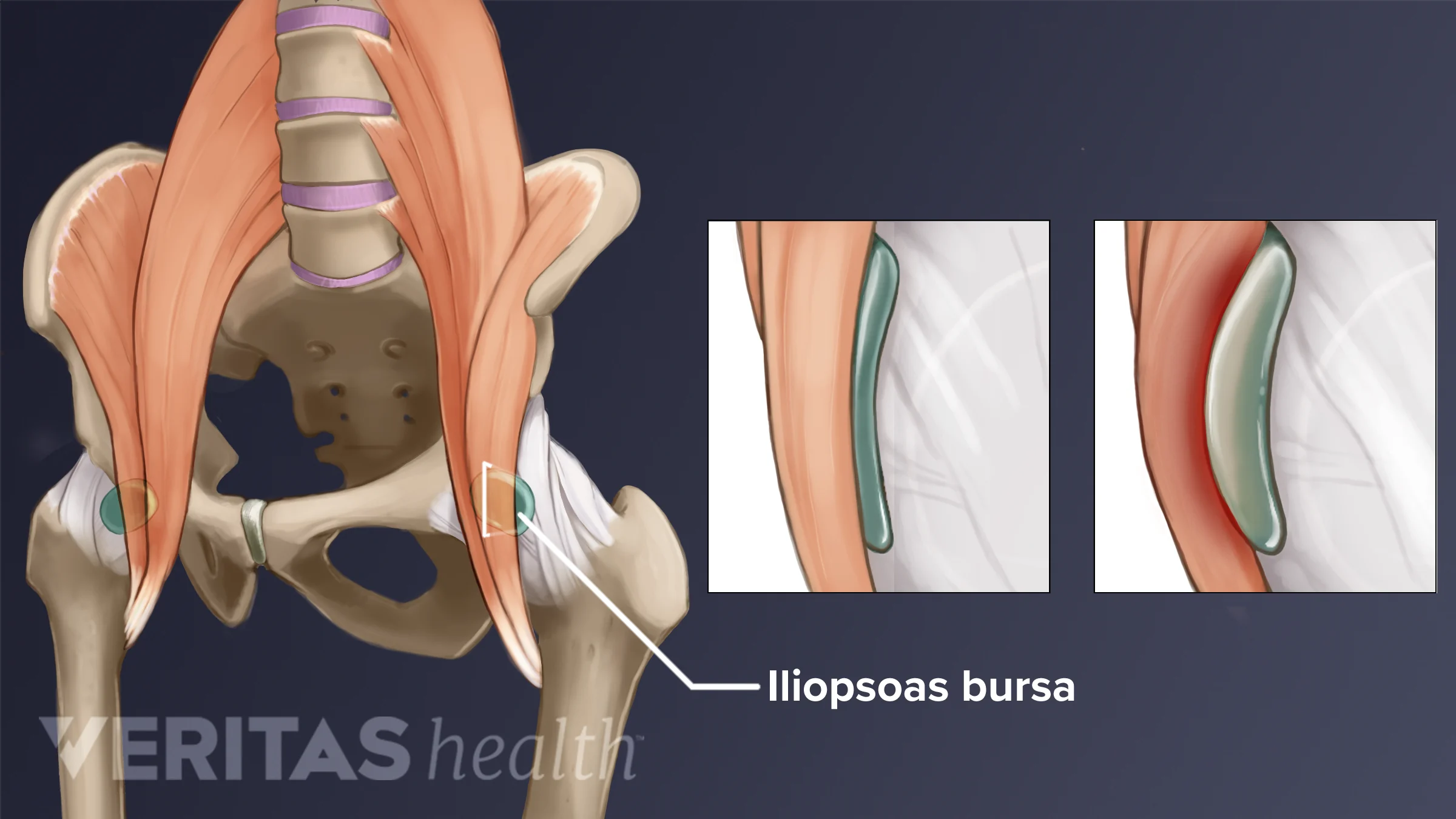 Hip Bursitis Symptoms | Arthritis-health