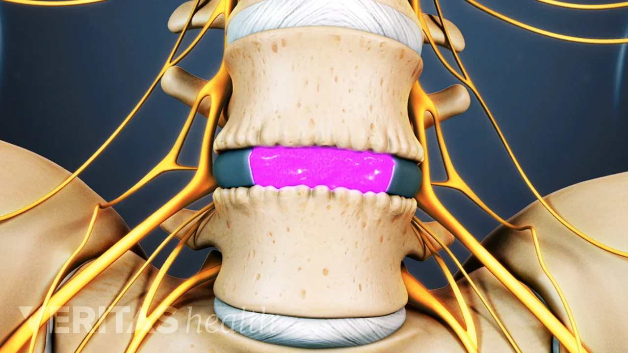 Autograft: The Patient's Own Bone | Spine-health