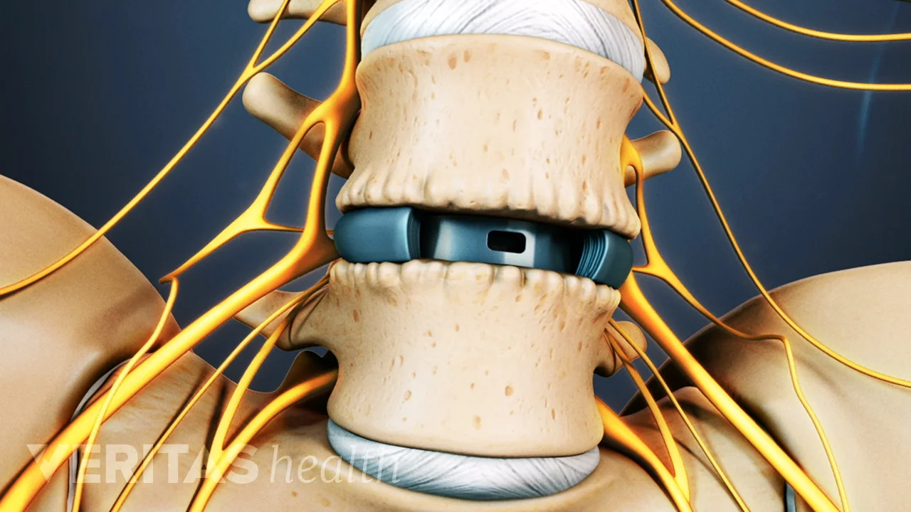 ALIF (Anterior Lumbar Interbody Fusion) Video | Spine-health