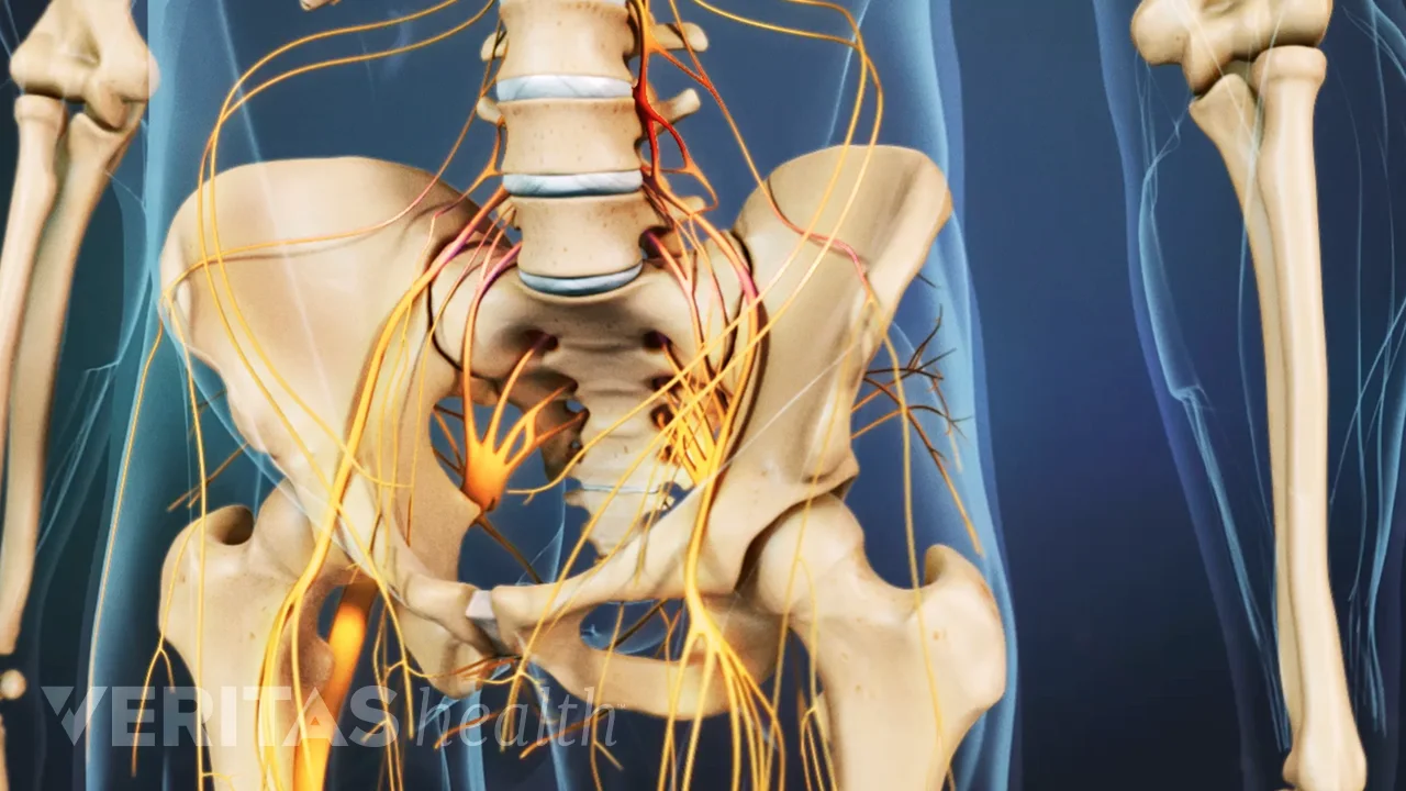 Cauda Equina Syndrome | Spine-health