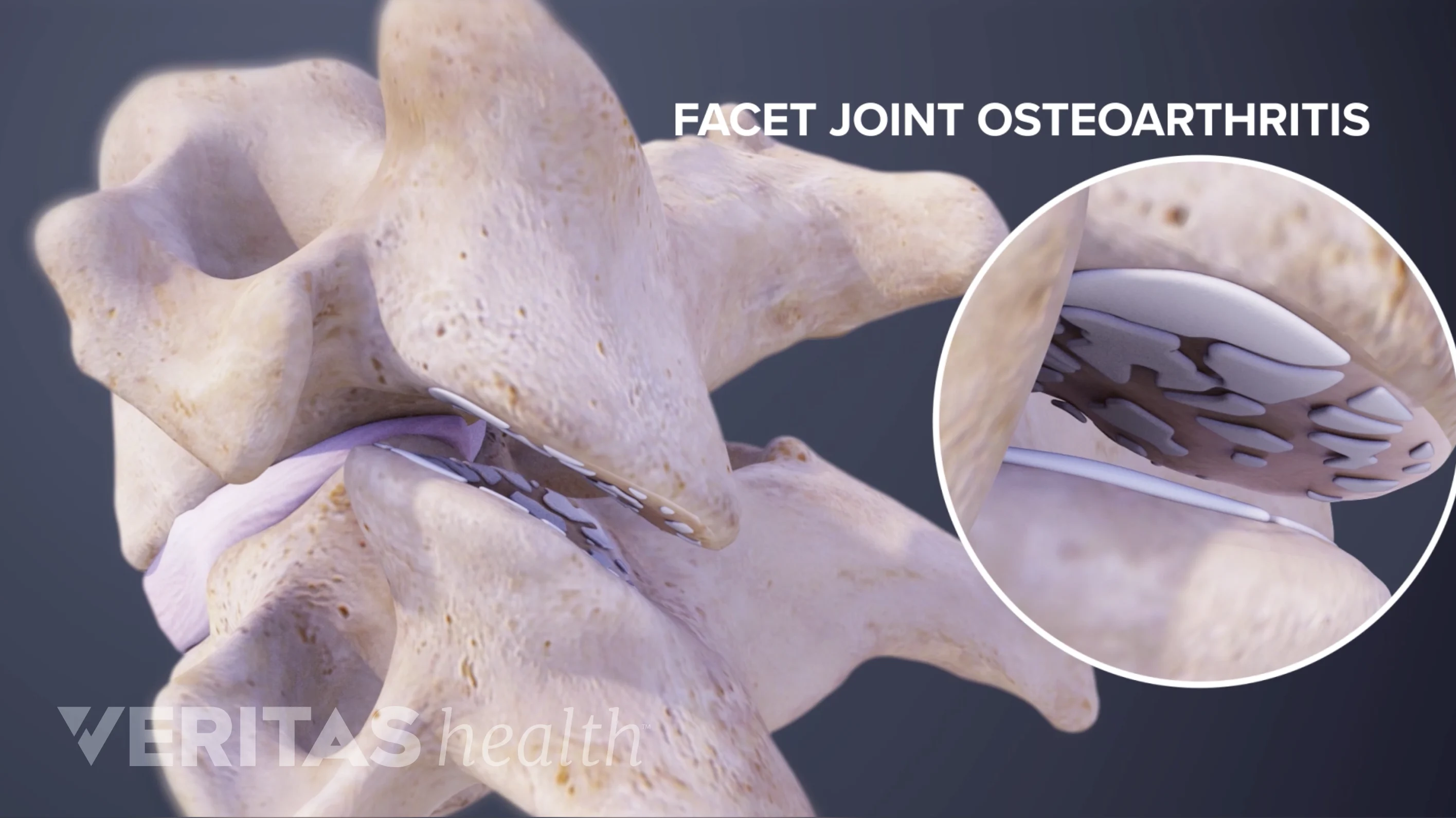 Causes of Lumbar Facet Joint Disorders | Spine-health