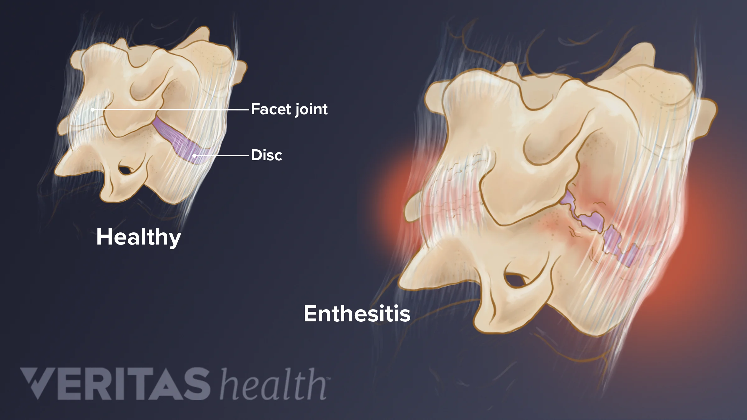 Neck Pain from Ankylosing Spondylitis | Spine-health