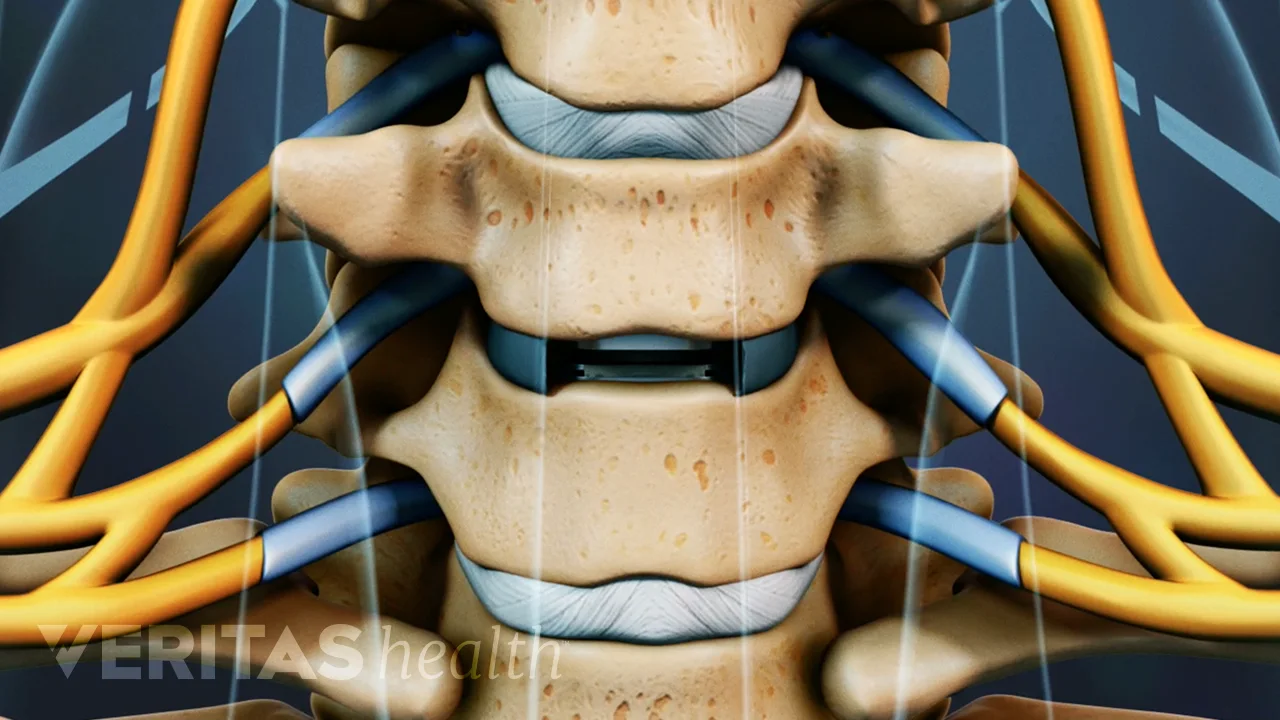 Artificial Disc Replacement | Spine-health