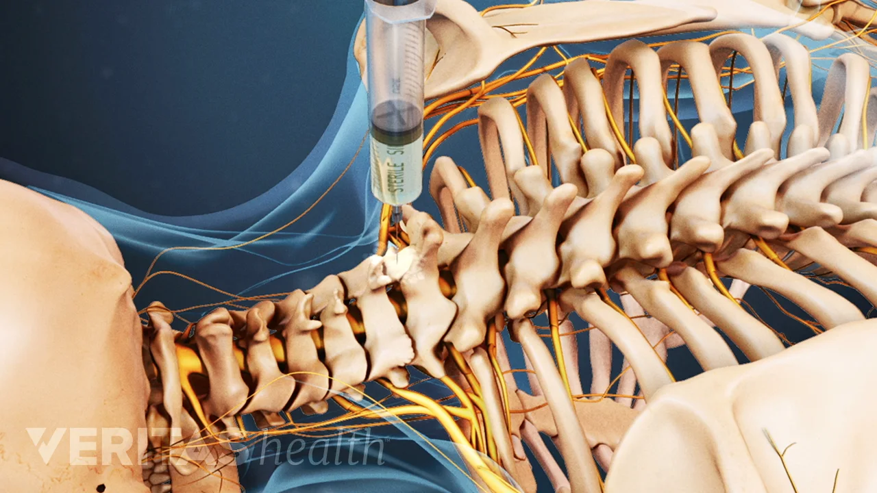 How Cervical Selective Nerve Root Blocks Can Ease Neck Pain | Spine-health