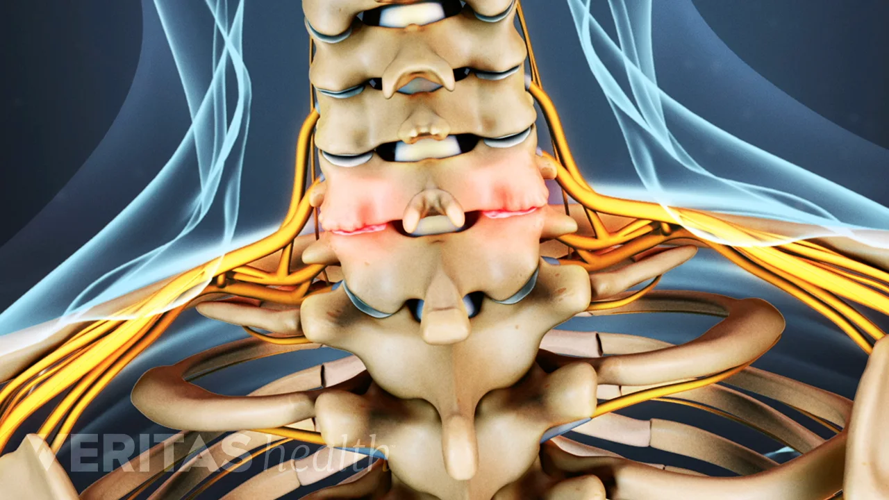 Cervical Osteophytes: Bone Spurs in the Neck | Spine-health