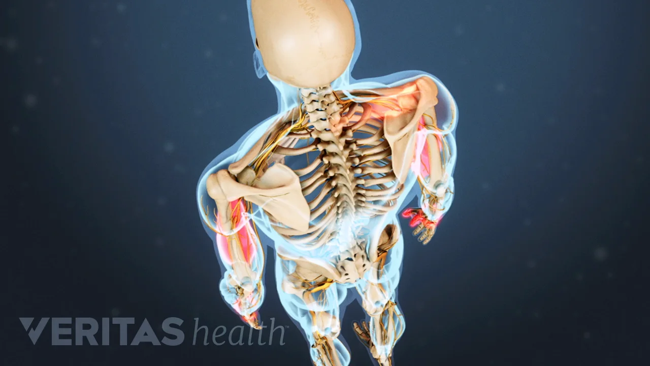 All About Neuropathy And Chronic Back Pain | Spine-health