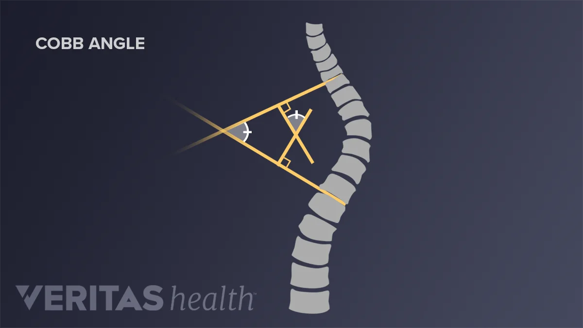 Cobb Angle Used to Measure Scoliosis Curves | Spine-health