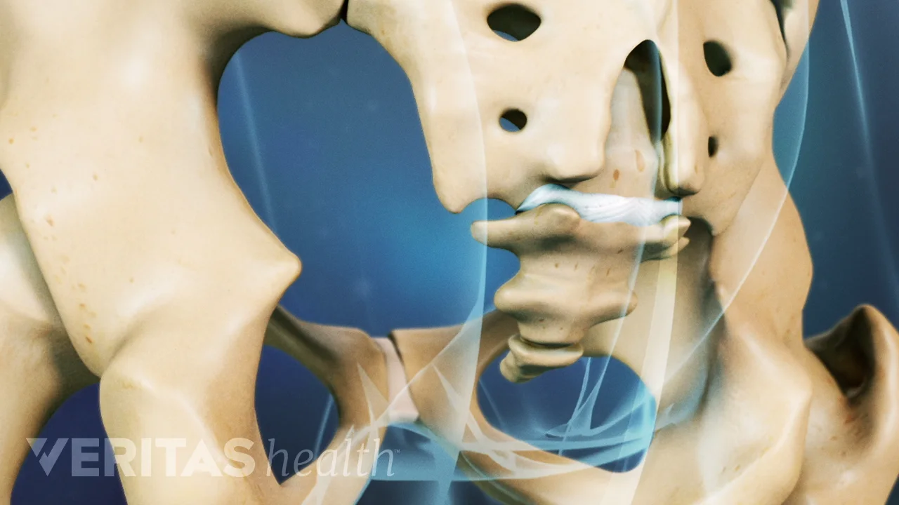 Coccygectomy Surgery for Coccydynia (Tailbone Pain) | Spine-health