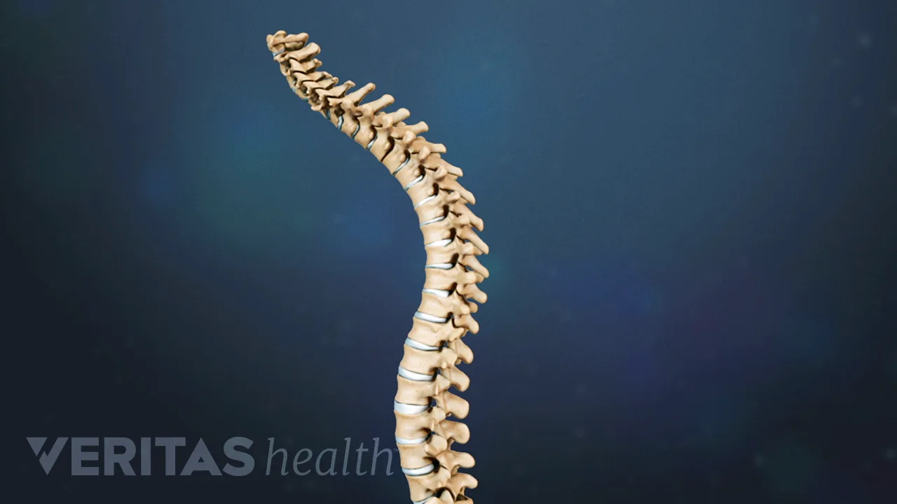 Symptoms and Diagnosis of Scheuermann's Disease | Spine-health