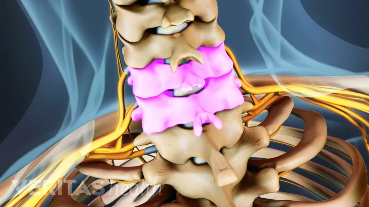 Outpatient Posterior Cervical Foraminotomy and Discectomy | Spine-health