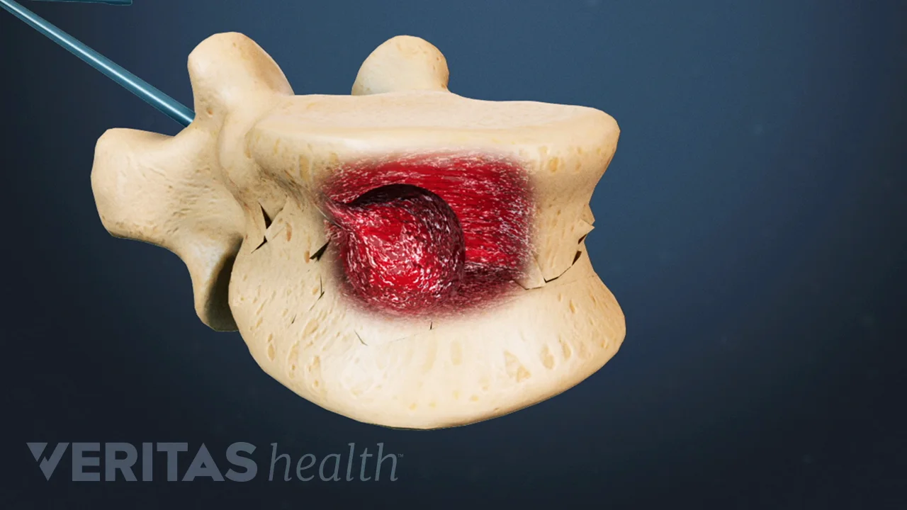 Kyphoplasty for Vertebral Compression Fractures | Spine-health