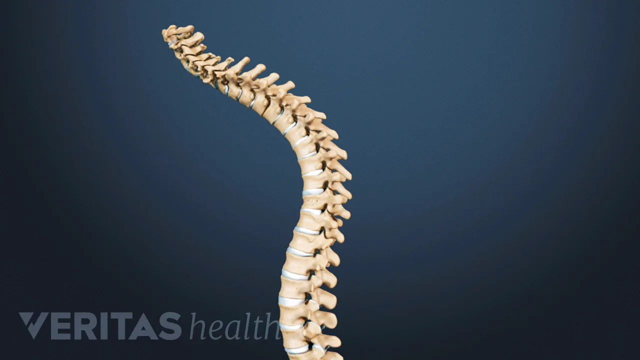 Kyphosis Causes and Treatment | Spine-health