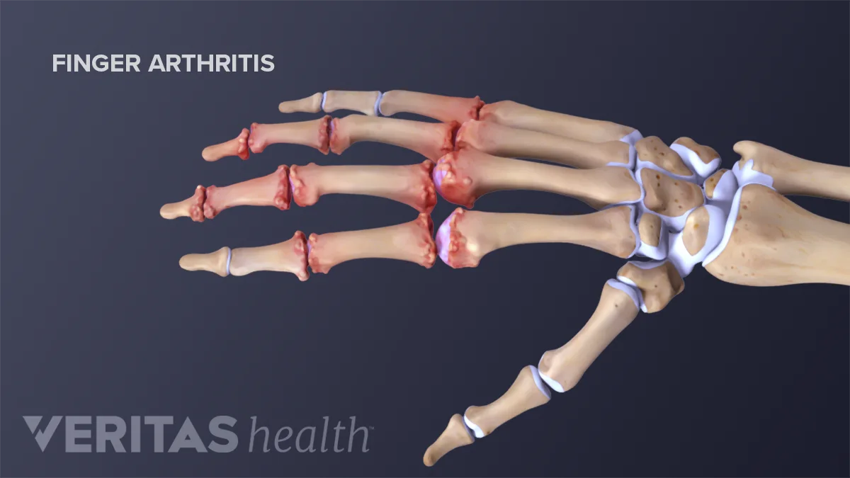 Recognizing Osteoarthritis in the Hand | Arthritis-health